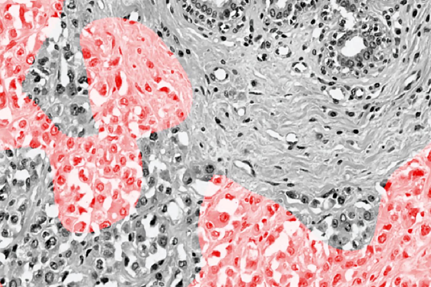 Breast Cancer Cells [IMAGE] | EurekAlert! Science News Releases