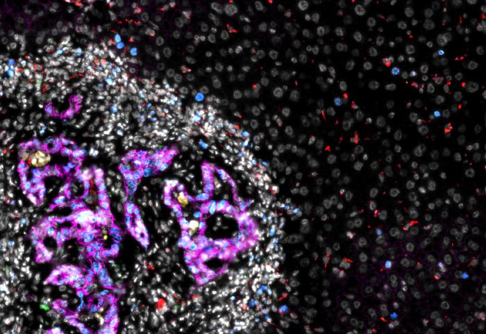 Colorectal cancer metastasis [IMAGE] | EurekAlert! Science News Releases