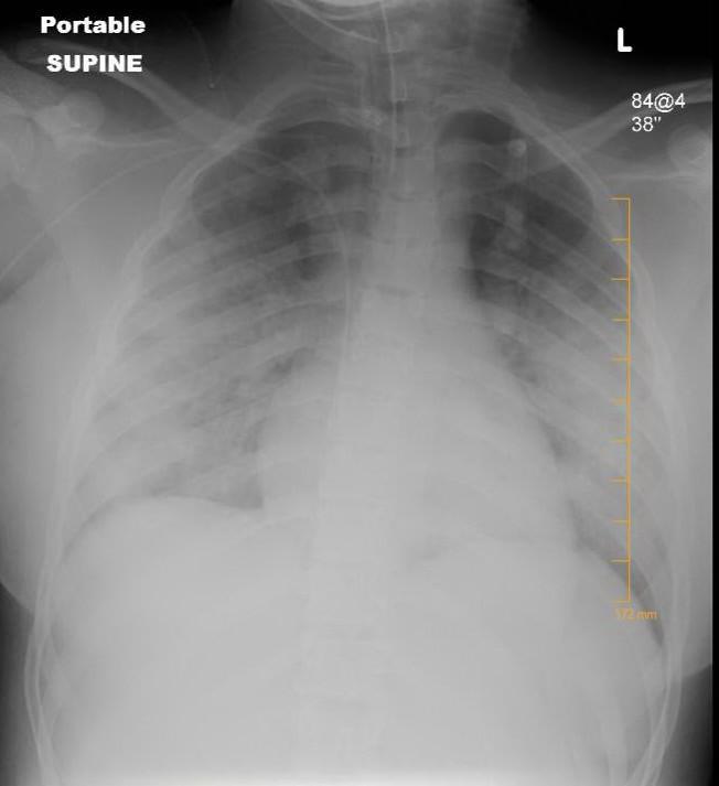 ARDS [IMAGE] | EurekAlert! Science News Releases