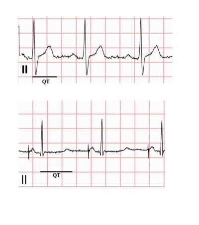 LQTS Patient ECG [IMAGE] | EurekAlert! Science News Releases