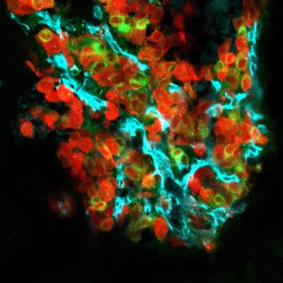 Bone Metastasis [IMAGE] | EurekAlert! Science News Releases
