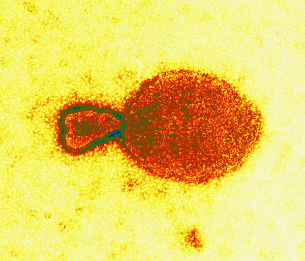 World-first human Hendra virus clinical trial | EurekAlert!