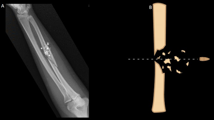 Radiographs of Left Forearm in [IMAGE] | EurekAlert! Science News Releases