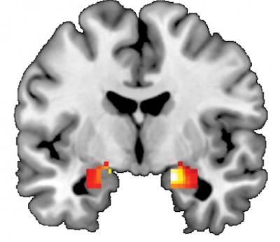Amygdala Activation [IMAGE] | EurekAlert! Science News Releases