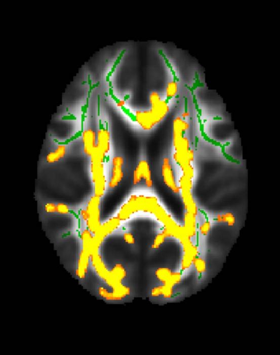 MRI Shows Increased Neuroinfla [IMAGE] | EurekAlert! Science News Releases