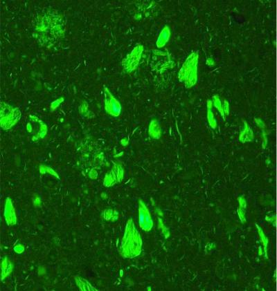 The Challenges Ahead for Alzheimer’s Disease | EurekAlert!