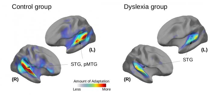 Dyslexic Brains Versus Control [IMAGE] | EurekAlert! Science News Releases