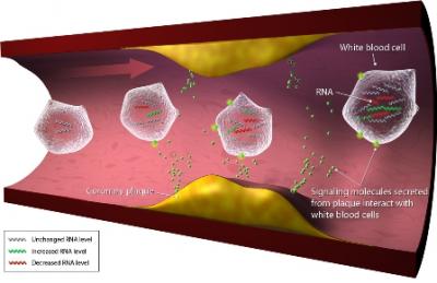 Gene Expression Test for CAD [IMAGE] | EurekAlert! Science News Releases