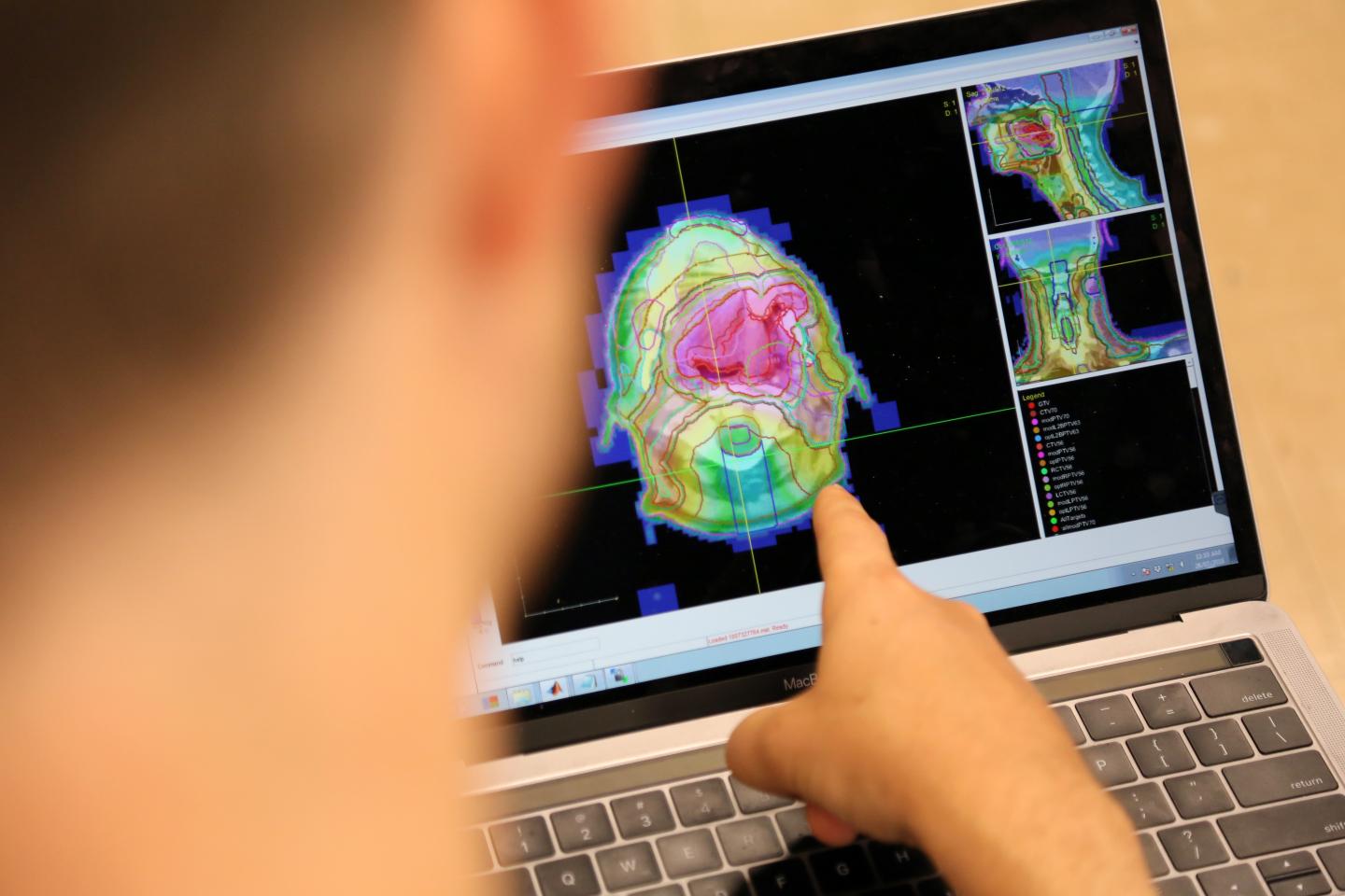 Treatment Plan Visualized [IMAGE] | EurekAlert! Science News Releases