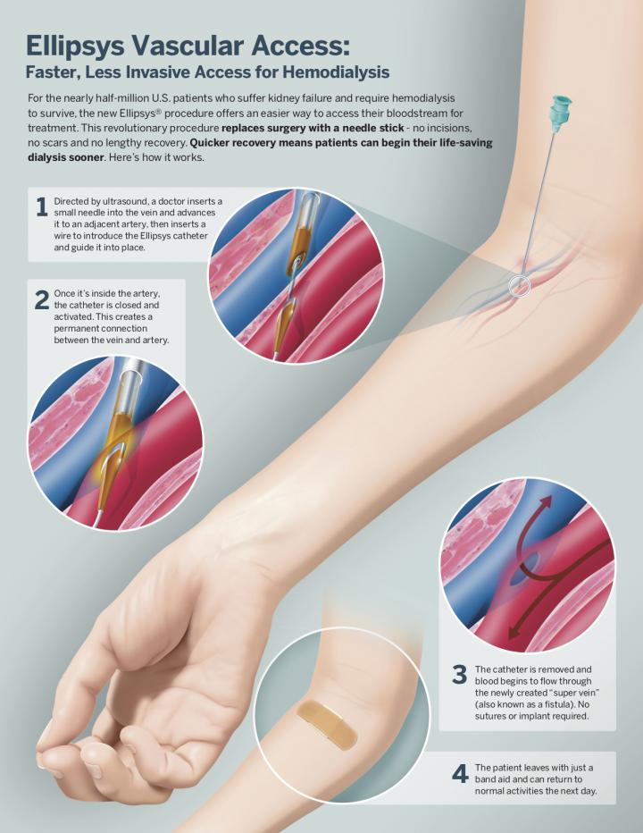 Ellipsys Infographic [IMAGE] | EurekAlert! Science News Releases