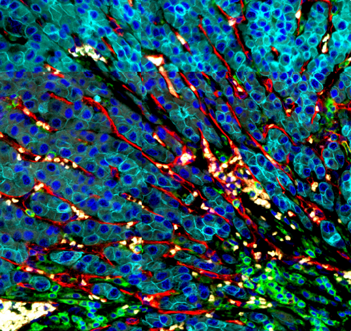 Microscopic image of a tumour [IMAGE] | EurekAlert! Science News Releases