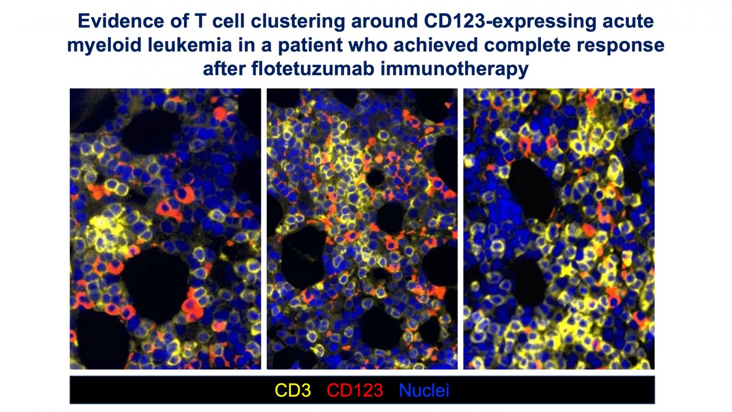 Leukemia Immune Profiles Predi [IMAGE] | EurekAlert! Science News Releases