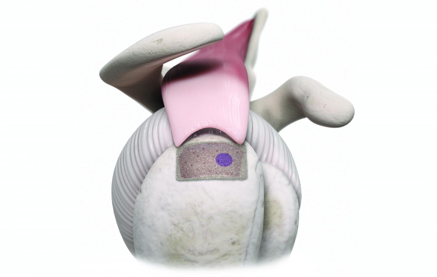 Rotator cuff implant [IMAGE] | EurekAlert! Science News Releases