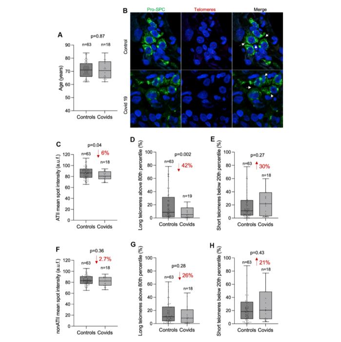 Short telomeres in alveolar type II cells ass | EurekAlert!