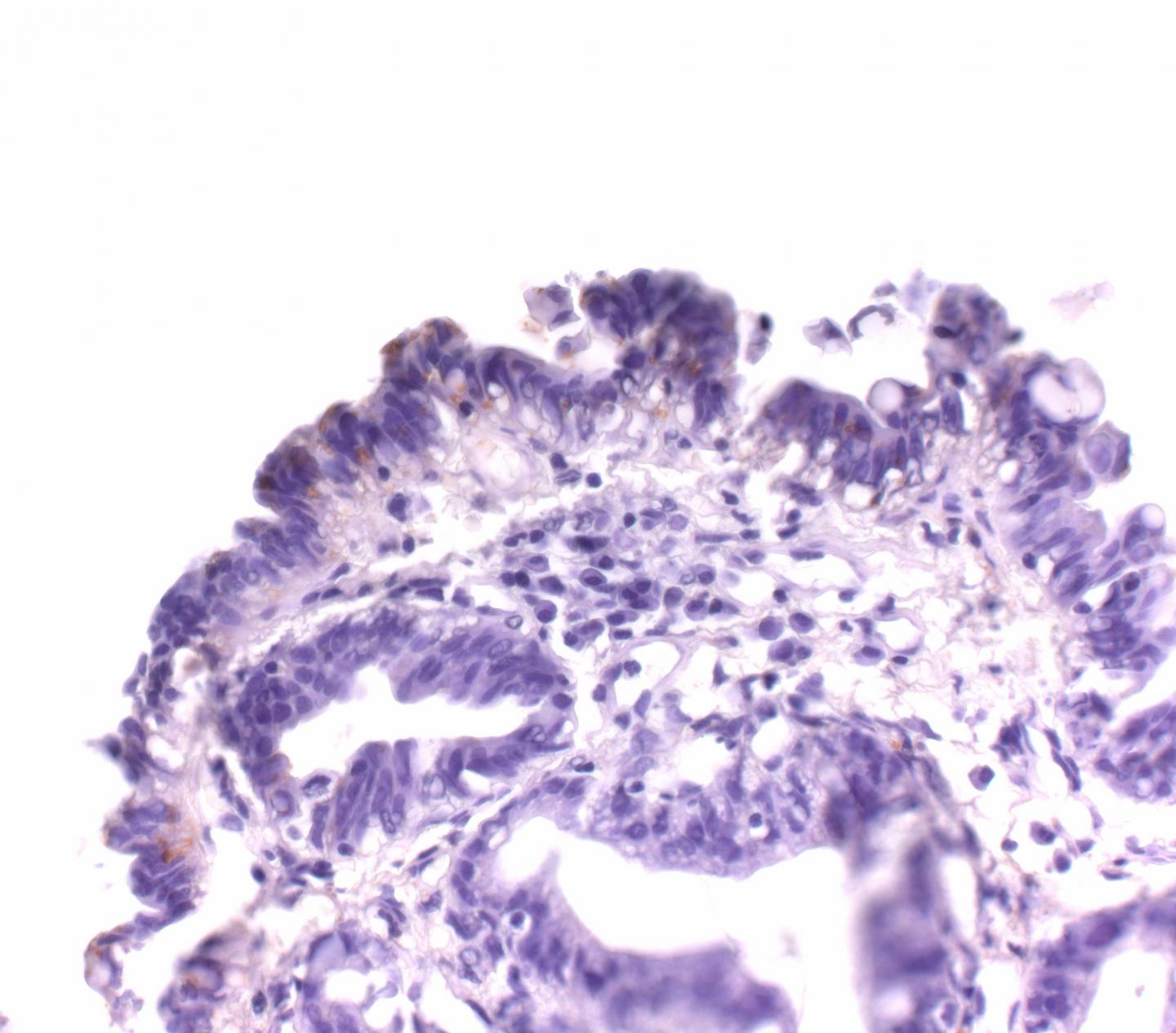 Gallbladder Carcinoma Tissue [IMAGE] | EurekAlert! Science News Releases