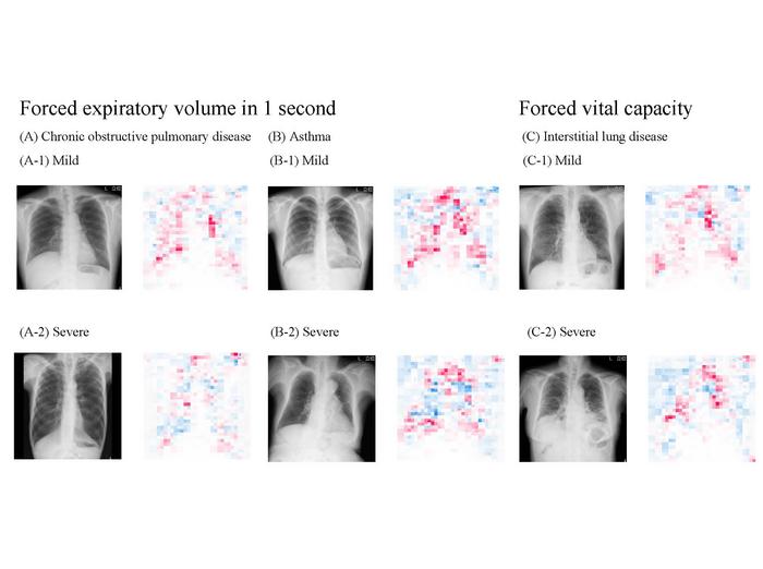 Chest radiographs and average [IMAGE] | EurekAlert! Science News Releases