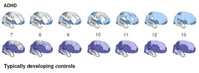 Cortex Maturation Delay in ADH [IMAGE] | EurekAlert! Science News Releases