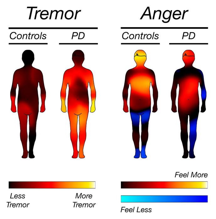 Emotions and Parkinsson's dise [IMAGE] | EurekAlert! Science News Releases