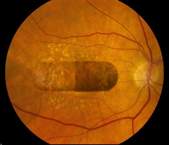 The AMD Eye [IMAGE] | EurekAlert! Science News Releases