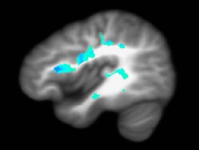 Normal Brain Development [IMAGE] | EurekAlert! Science News Releases