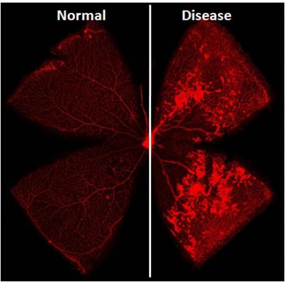 Normal vs. Diseased Retina [IMAGE] | EurekAlert! Science News Releases
