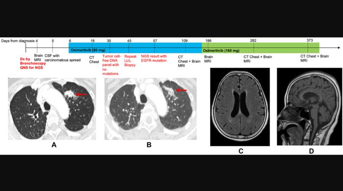 Case report: Lazarus effect in a patient trea | EurekAlert!