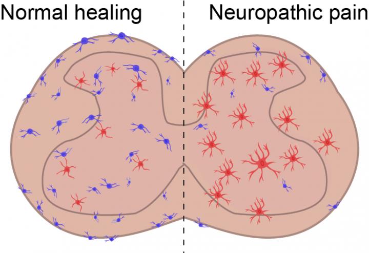 Neuropathic Pain [IMAGE] | EurekAlert! Science News Releases