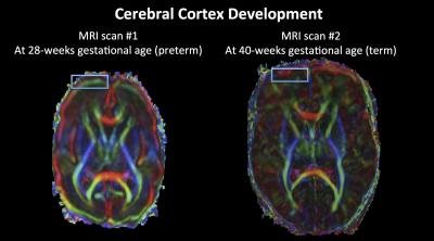 Clues to Cognitive Disabilities in Premature | EurekAlert!