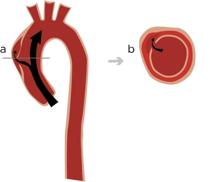 Genetic mutation linked to aortic dissection | EurekAlert!