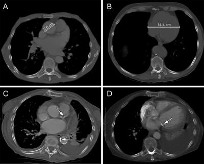 Chest CT helps predict cardiovascular disease | EurekAlert!