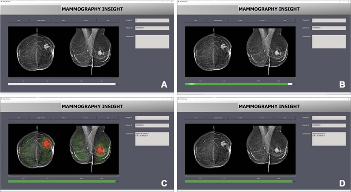 AI bias may impair radiologist accuracy on ma | EurekAlert!