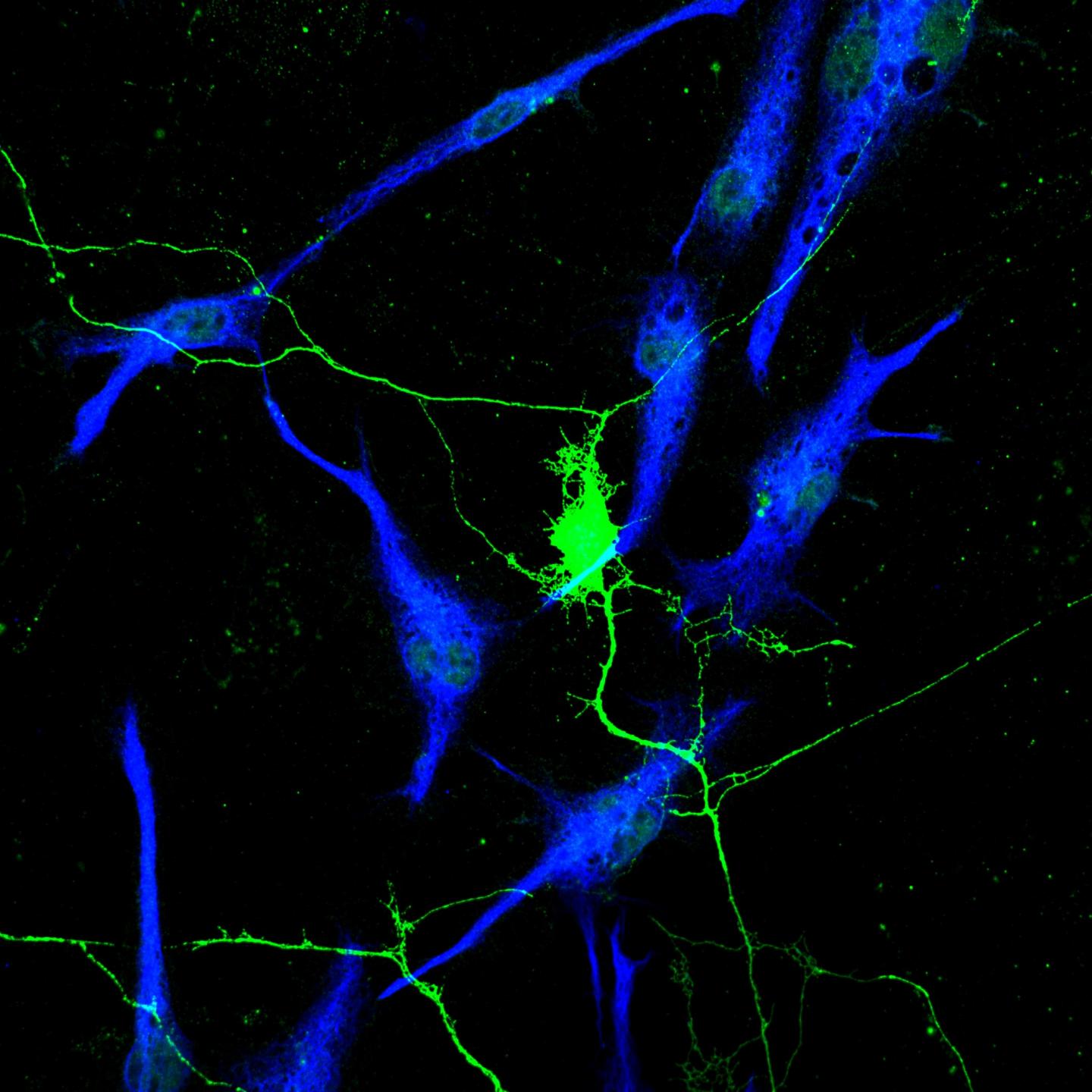 Neurons support cancer growth throughout the | EurekAlert!