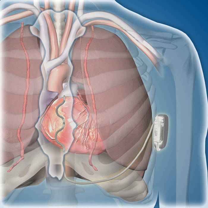 EVICD lead [IMAGE] | EurekAlert! Science News Releases