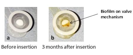 Voice Prosthesis Biofilm [IMAGE] | EurekAlert! Science News Releases