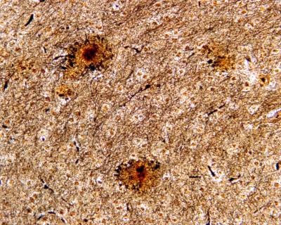 New Combination Drug Therapy f [IMAGE] | EurekAlert! Science News Releases