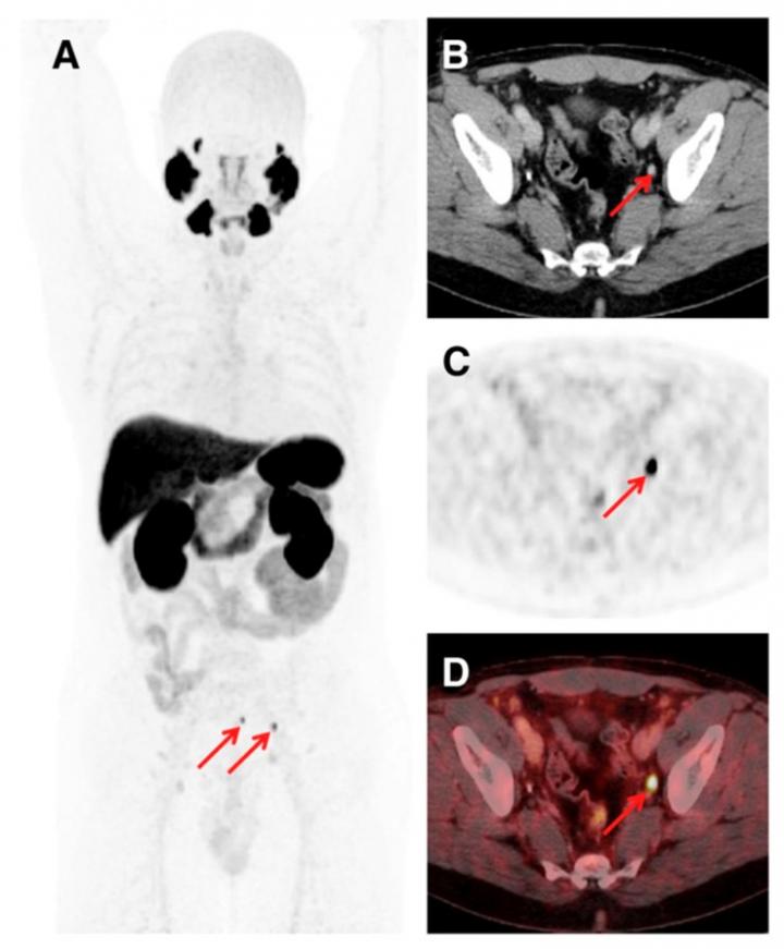 Clinical research for PET imaging for prostat | EurekAlert!