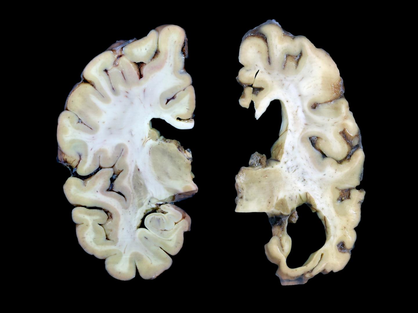 Normal brain/Alzheimer's brain [IMAGE] | EurekAlert! Science News Releases