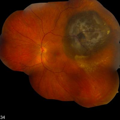 Cancerour Tumor in Eye [IMAGE] | EurekAlert! Science News Releases