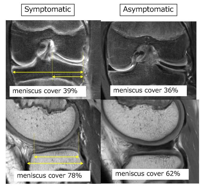 The size of your meniscus matters: Knee pain | EurekAlert!