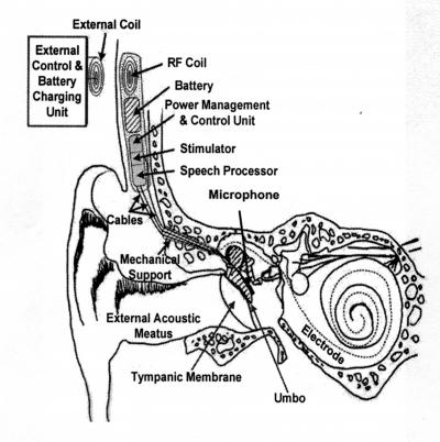 Proposed Fully Implantable Coc [IMAGE] | EurekAlert! Science News Releases