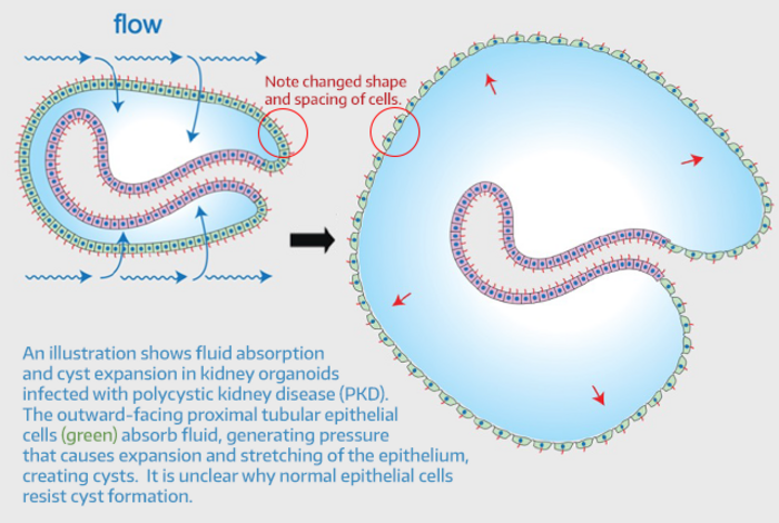 1-PKD cyst expansion [IMAGE] | EurekAlert! Science News Releases