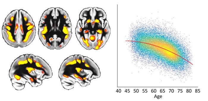 Brain ageing risk factors [IMAGE] | EurekAlert! Science News Releases