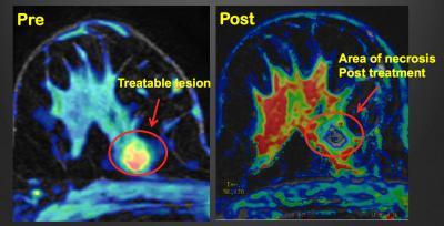 Pre- and Post-Treatment Transv [IMAGE] | EurekAlert! Science News Releases
