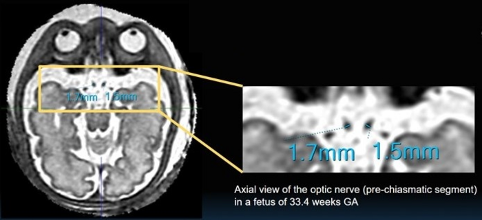 Optic nerve measurement [IMAGE] | EurekAlert! Science News Releases