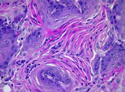 Histology of sox2/lkb1 Lung Tu [IMAGE] | EurekAlert! Science News Releases