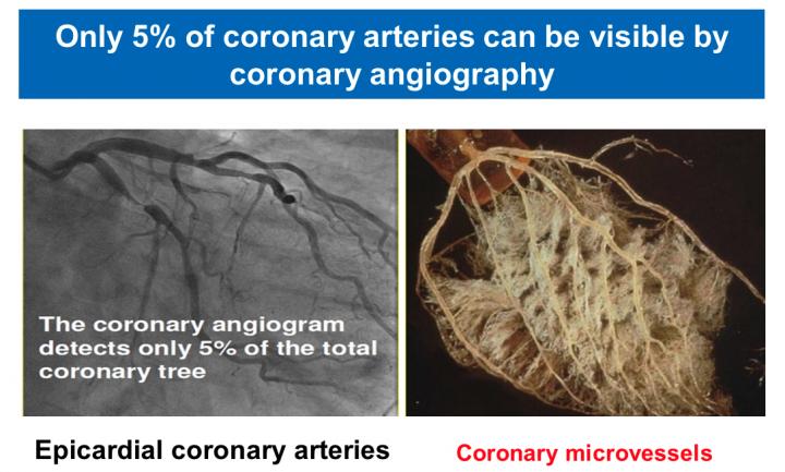 Microvascular angina is import [IMAGE] | EurekAlert! Science News Releases