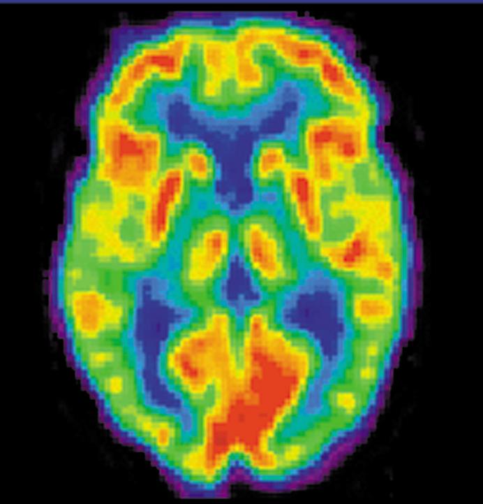PET Scan [IMAGE] | EurekAlert! Science News Releases