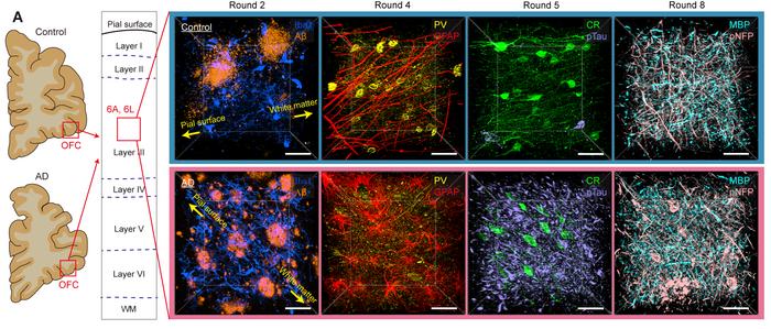 Alzheimer's comparison [IMAGE] | EurekAlert! Science News Releases