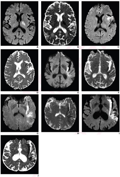 Acute ischemic stroke patients [IMAGE] | EurekAlert! Science News Releases