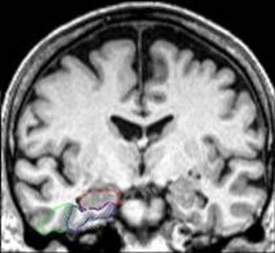 MRI brain scans accurate in early diagnosis o | EurekAlert!